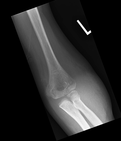 Supracondylar Fracture - Pediatric - Pediatrics - Orthobullets